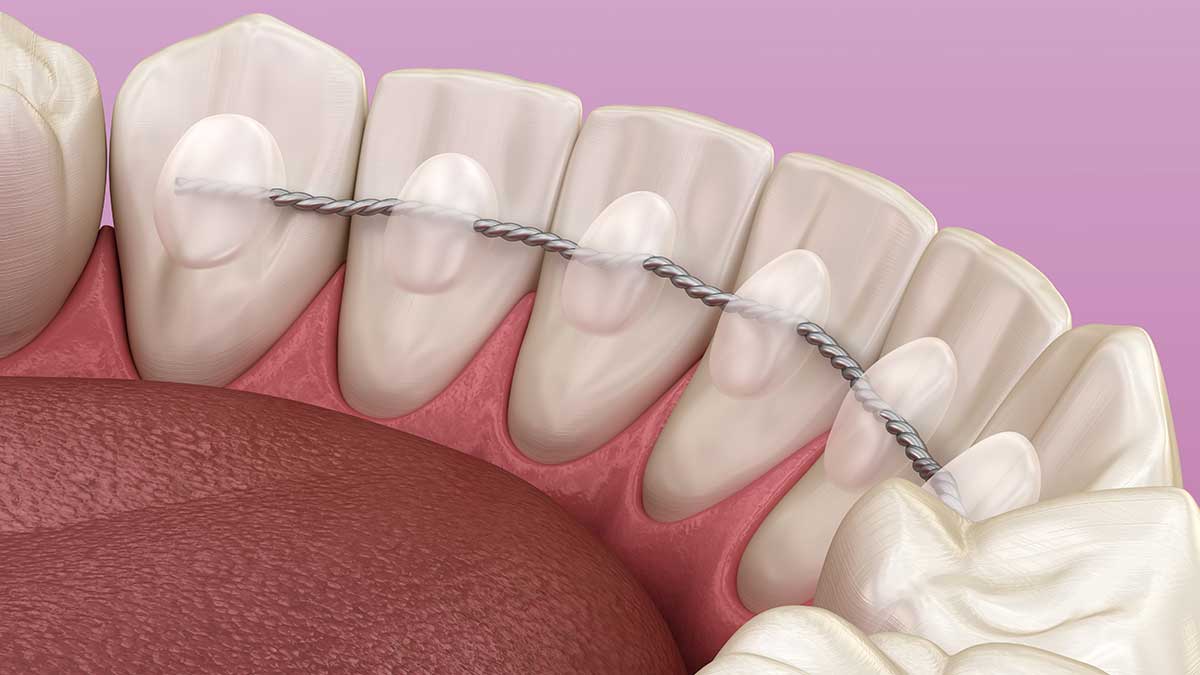Fixed Retainers Philadelphia PA Aces Braces Philadelphia
